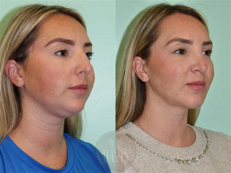 Buccal Fat Removal Before And After Pictures Case 1166 Tampa Fl