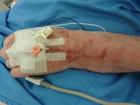 Phlebitis As A Consequence Of Peripheral Intravenous Administration Of