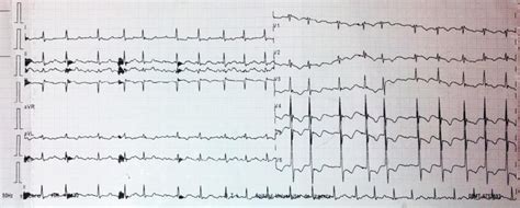 Atrial Flutter With Variable Atrio Ventricular Block And