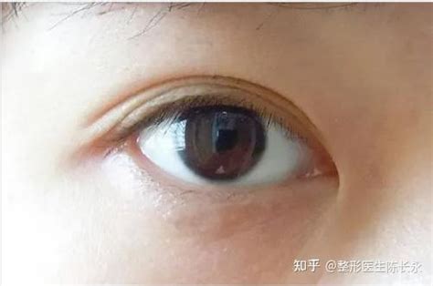 三眼皮如何恢复成双眼皮 知乎