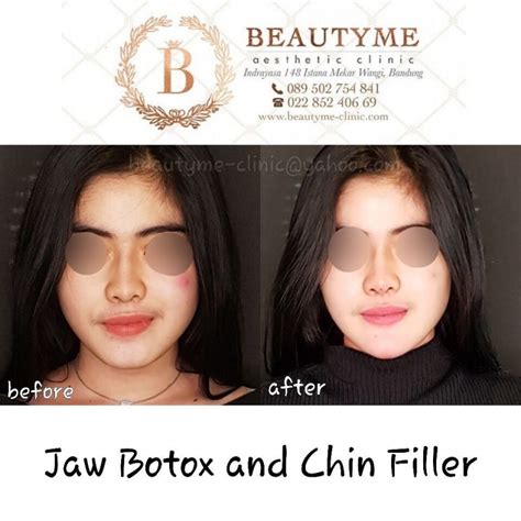 Mesoslim Body Injection Dokter Mesoslim Body Injection Jawa Barat