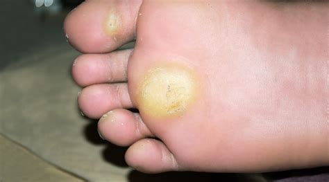 Foot Callus Formation At Chelsea Frome Blog