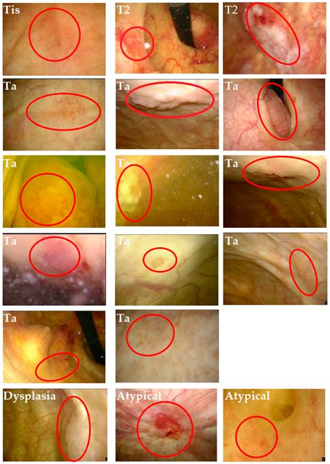 Cystoscopy Accuracy In Detecting Bladder Tumors A Prospective Video