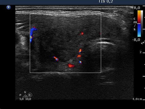 Subacute Thyroiditis