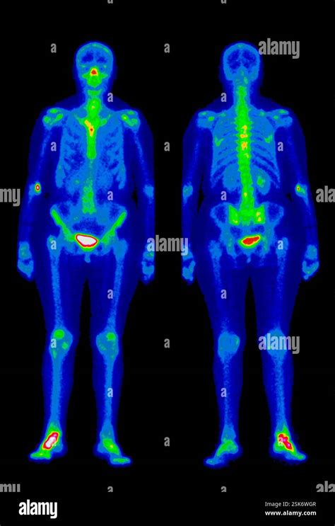 Algodystrophy Of The Foot Scintigram Algodystrophy Reflex
