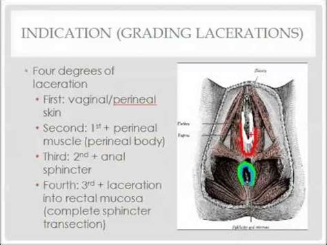 Perineal Laceration Repair Description Indications And Questions