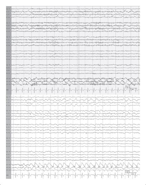JLE Epileptic Disorders Cortical Surface Intracranial Electrodes Identify Clinically