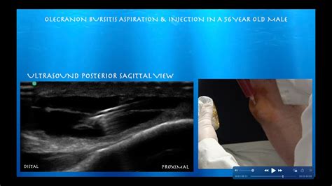 Cortisone Injection For Scapular Bursitis At Sandra Willis Blog