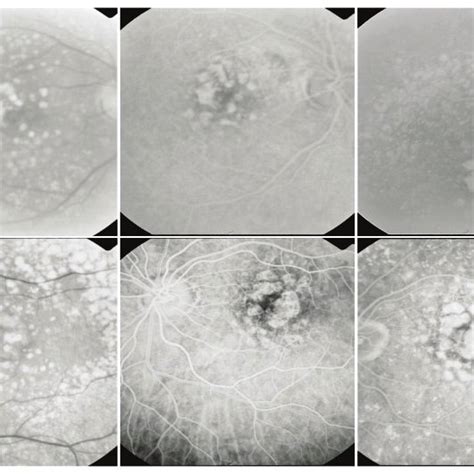 Type 1 Occult Cnv Fibrovascular Rpe Detachment Download Scientific Diagram