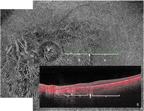 Swept Source Widefield Optical Coherence Tomography Angiography Montage Download Scientific