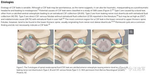 自发性低颅压的发病机制 知乎