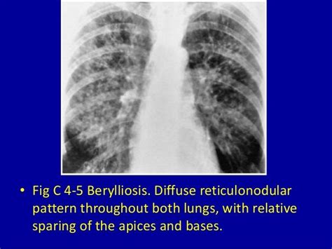 4 Diffuse Reticular Or Reticulonodular Pattern