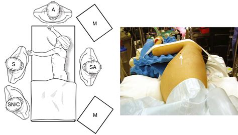 Thoracoscopic Decortication And Debridement For Empyema Clinical Tree