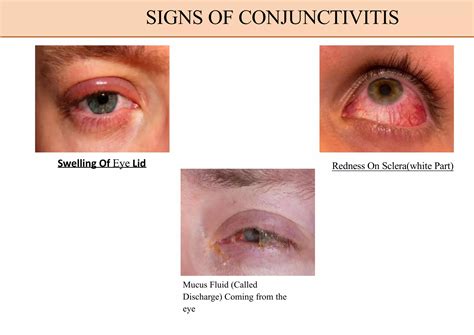 Conjunctivatis Presentationajpptx