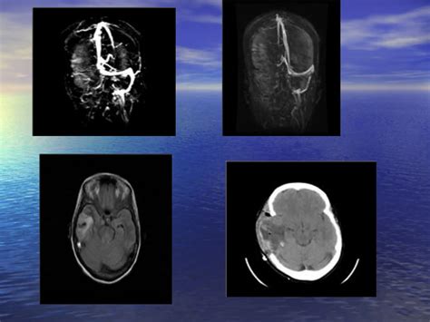 Decompressive Craniectomy And Its Managemnet Ppt