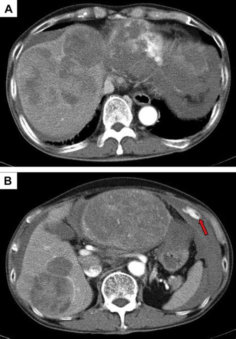 Computed Tomography Scan With Contrast Showing A Ruptured Solid