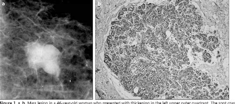 Figure 1 From Sclerosing Adenosis Of The Breast Radiologic Appearance