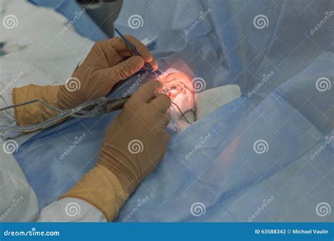 Cataract Extraction Unit At Milla Stelzer Blog