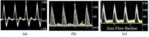 New Approach To Measuring The Ankle And Toe Brachial Indices As New