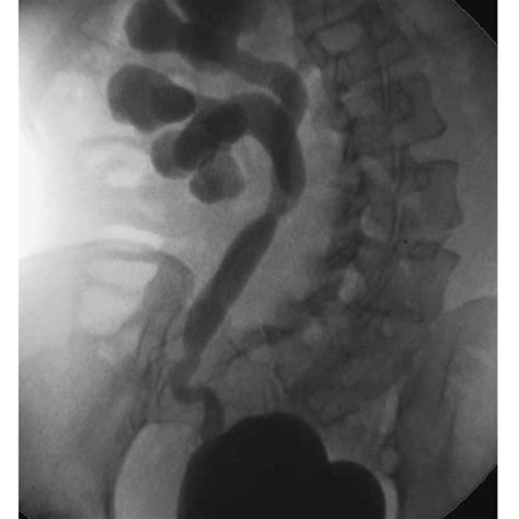 Cystogram Showing A Grade Iv Vesicoureteral Reflux And Grade Iii Download Scientific Diagram