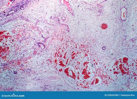 Teratoma Light Micrograph Stock Image Image Of Circle 228342385