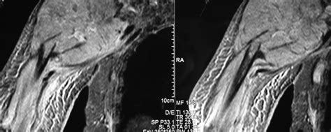 Pathologic Fracture Of Humerus Proximal Humerus Tumor Radiopaedia