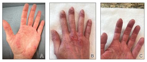 Concurrent Atopic Dermatitis And Psoriasis Successfully Treated With