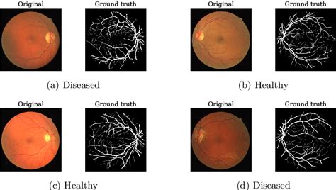 Explainable Convolutional Neural Networks For Retinal Fundus