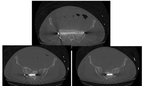 Post Operative Axial Ct Scan Revealing Trajectory Of S1 And
