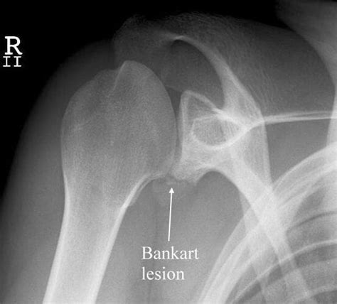 Bankart Fracture What Is A Bankart Lesion Signs Symptoms And