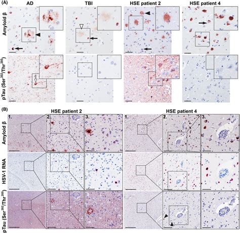 Lytic Hsv Infection Is Not Consistently Associated With Aberrant Aβ Or