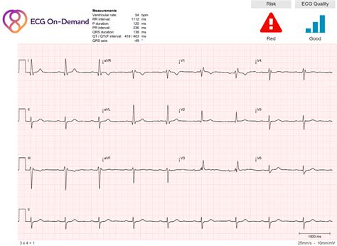 Trifascicular Block Ecg Pedia At Brandon Myers Blog