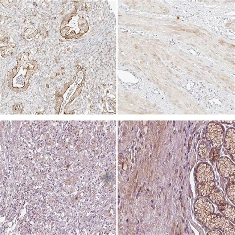 Protein Expression Patterns Of Gnas A And Txnip B In Gastric Download Scientific Diagram