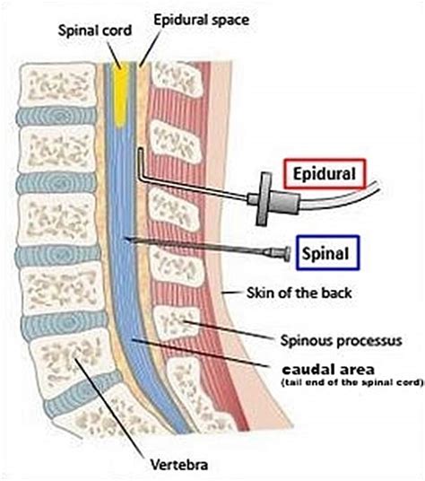 What Is The Definition Of A Epidural Block At Kerry Palacios Blog