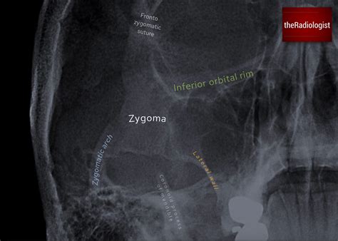 Facial Bone X Ray Guide The Radiologist