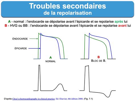 Troubles Secondaires De Repolarisation E Cardiogram