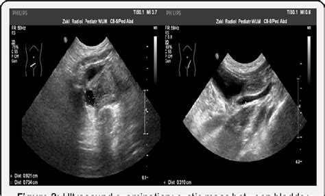 Gartners Duct Cyst Ultrasound