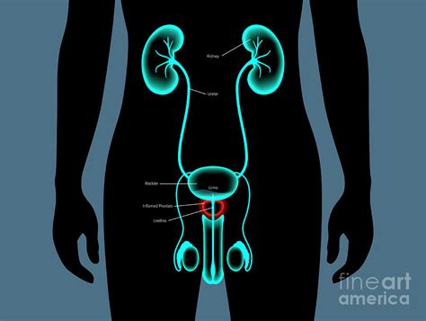 Prostatitis 6 Photograph By Pikovit Science Photo Library Pixels