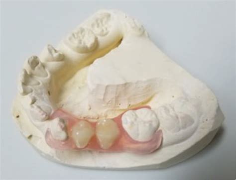 Unilateral Removable Partial Denture