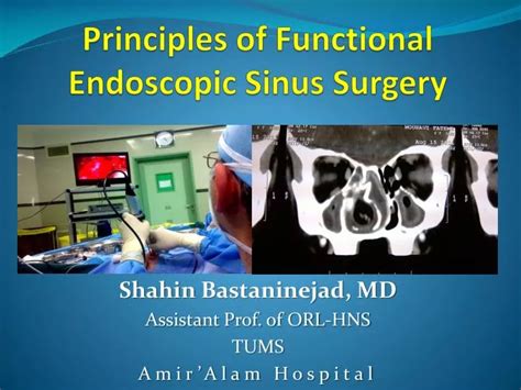 Ppt Principles Of Functional Endoscopic Sinus Surgery Powerpoint Presentation Id4208036