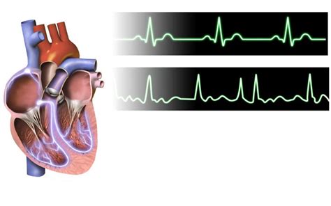 Mayo Clinic Tests Ai Technology To Detect Atrial Fibrillation