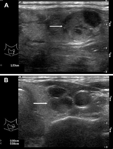 Thyroid Hypoechoic Area At Zane Morrison Blog