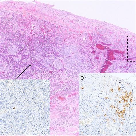 EGD And The Biopsy Results At A Local Clinic A EGD With Conventional Download Scientific