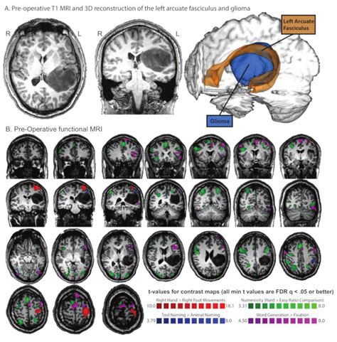 Pre Operative Functional Mri And Diffusion Tensor Imaging Dti In Download Scientific Diagram