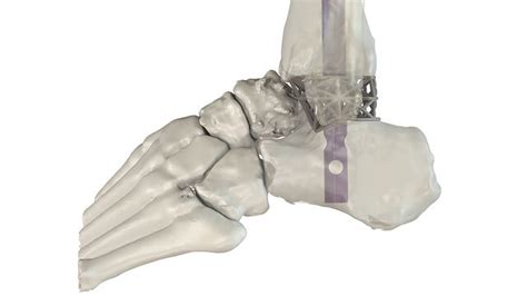 Cis Upper Limb Lrs Implants