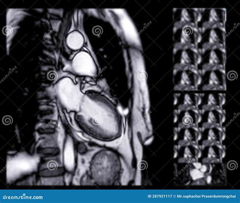 Mri Heart Or Cardiac Mri Magnetic Resonance Imaging Of Heart For