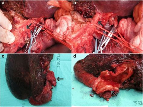 Isolated Igg4 Related Sclerosing Cholangitis Misdiagnosed As Malignancy