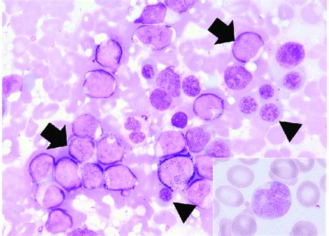 Multiple Blasts Arrows Admixed With Erythroid Precursor Cells Arrow