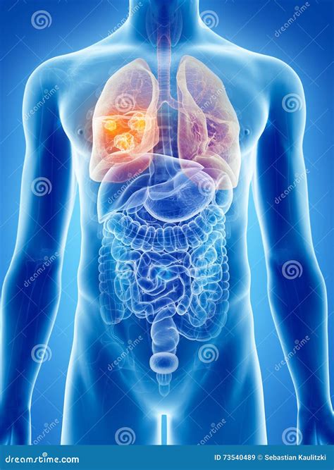 Lung Cancer Stock Illustration Illustration Of Rendered 73540489