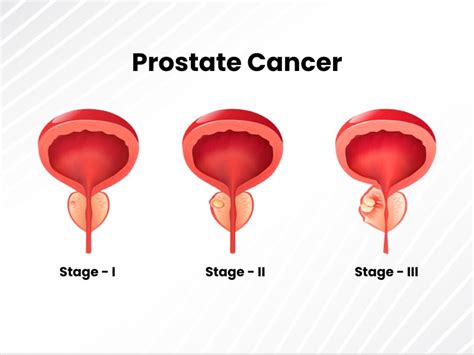 Prostate Cancer Early Detection And Treatment Options
